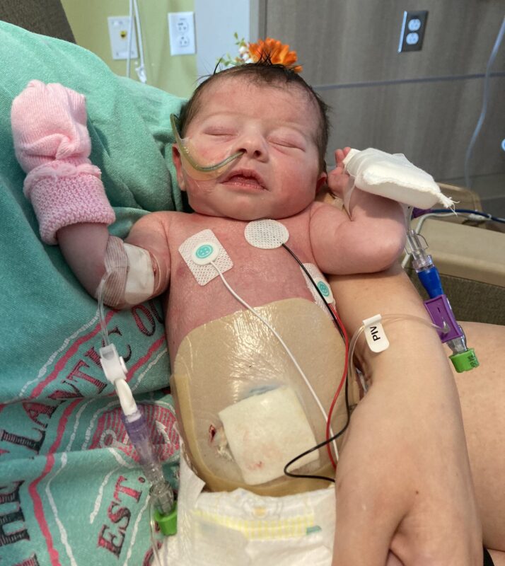 gastroschisis awareness Archives : Inside Children's Blog