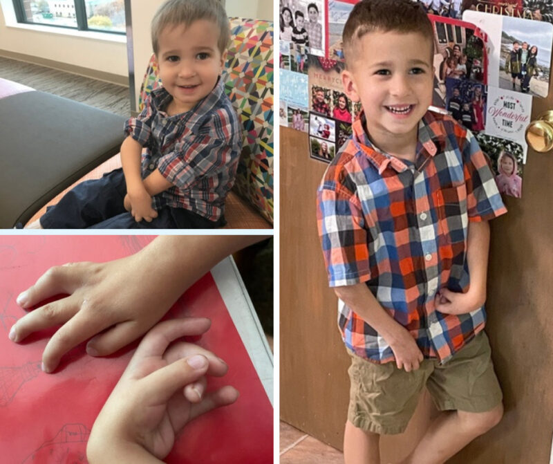 New procedure helps patient with arthrogryposis : Inside Children's Blog