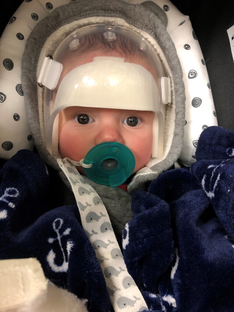 Lorain toddler is healthy and thriving after craniosynostosis surgery ...