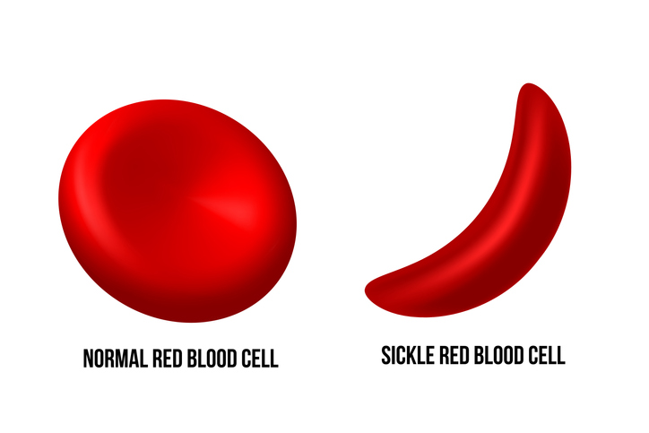What is sickle cell disease? : Inside Children's Blog