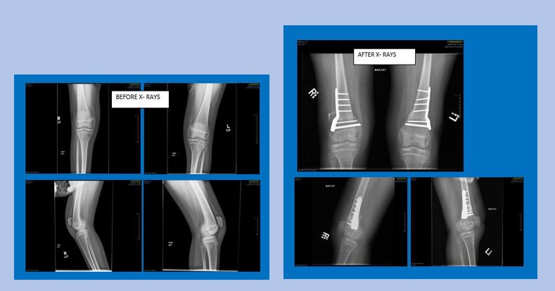 Orthopedic surgery corrects musculoskeletal issues for teen with ...