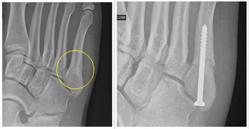 Canfield football player is back in the game thanks to great care ...