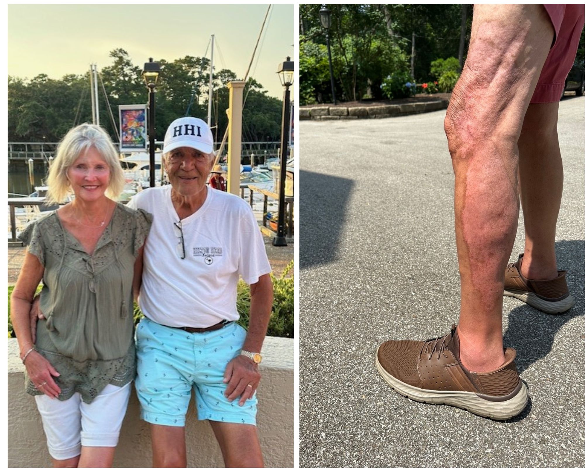 Patients overcome severe burns with minimal scarring thanks to ...