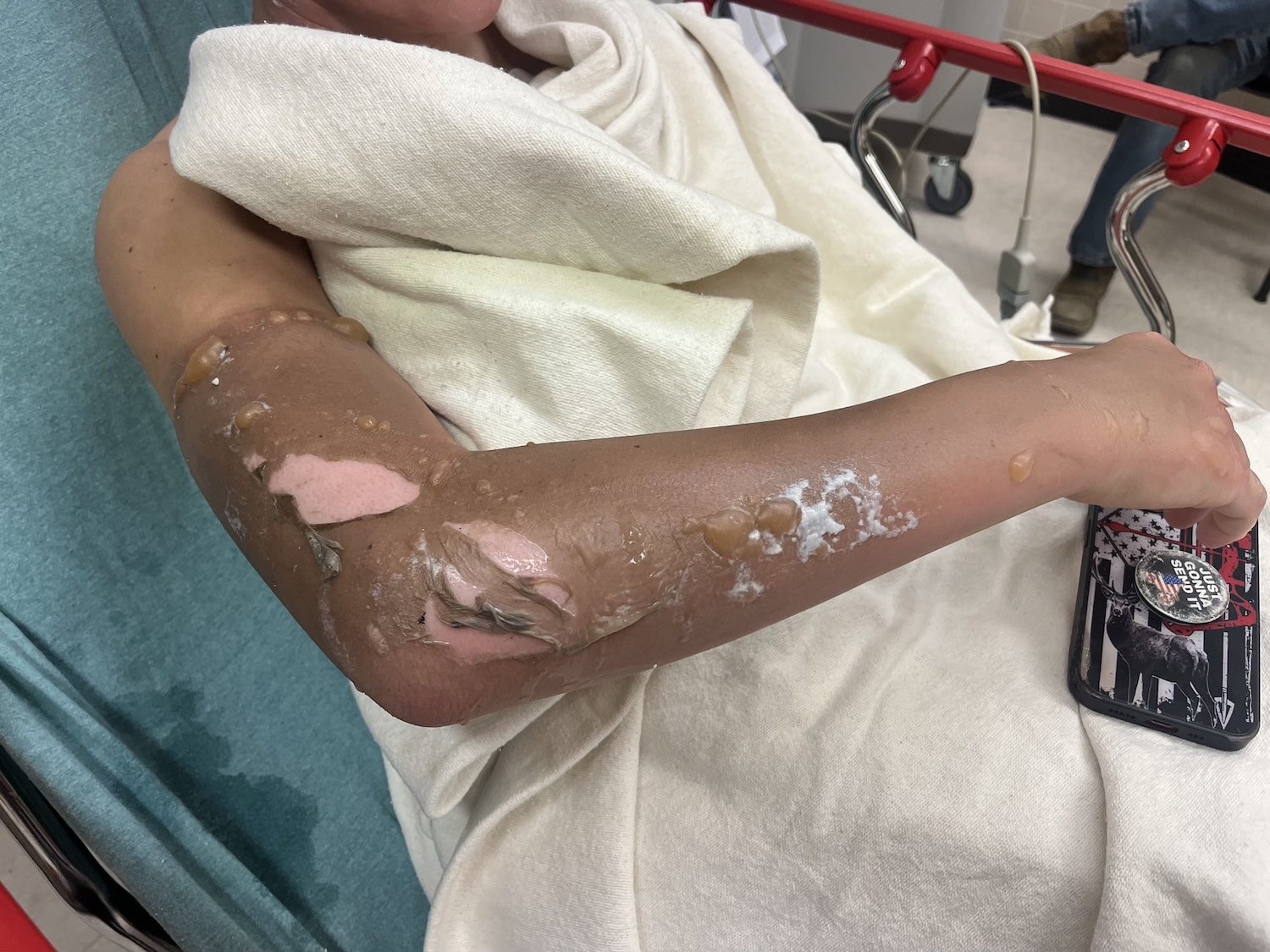 Innovative treatment for severe burns speeds healing, minimizes ...
