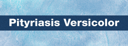 Kidshealth: Pityriasis Versicolor | Akron Children's Hospital