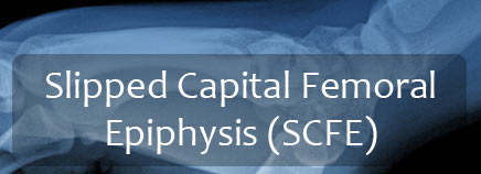 Kidshealth: Slipped Capital Femoral Epiphysis (SCFE) | Akron Children's ...