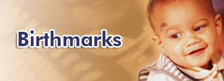 Kidshealth: Birthmarks | Akron Children's Hospital