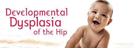 Kidshealth: Developmental Dysplasia of the Hip | Akron Children's Hospital