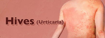 Kidshealth: Hives (Urticaria) | Akron Children's Hospital
