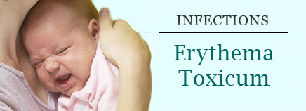 Kidshealth: Erythema Toxicum | Akron Children's Hospital