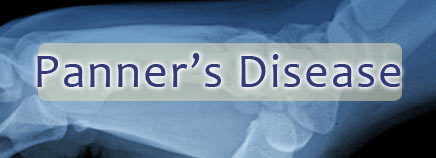 Kidshealth: Panner's Disease | Akron Children's Hospital