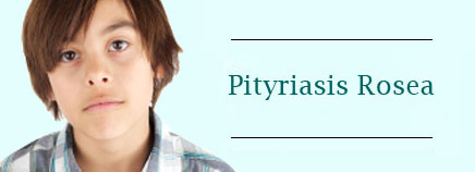 Kidshealth: Pityriasis Rosea | Akron Children's Hospital