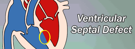 Kidshealth: Ventricular Septal Defect | Akron Children's Hospital