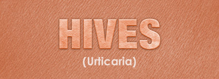 Kidshealth: Hives (Urticaria) | Akron Children's Hospital