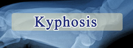 Kidshealth: Kyphosis | Akron Children's Hospital