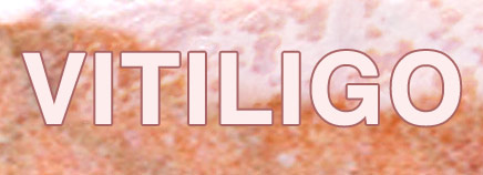 Kidshealth: Vitiligo | Akron Children's Hospital