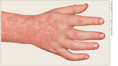 Kidshealth: Fifth Disease | Akron Children's Hospital