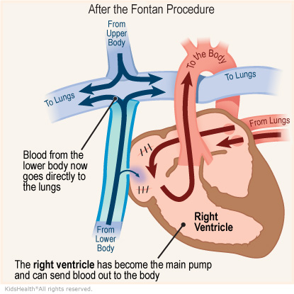 Kidshealth: Hypoplastic Left Heart Syndrome Surgery: The Fontan ...