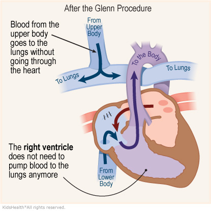 Kidshealth: Hypoplastic Left Heart Syndrome Surgery: The Glenn ...