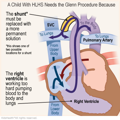 Kidshealth: Hypoplastic Left Heart Syndrome Surgery: The Glenn ...