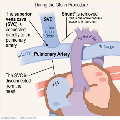 Kidshealth: Hypoplastic Left Heart Syndrome Surgery: The Glenn ...