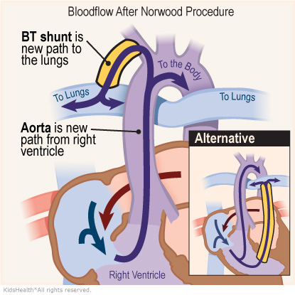 Kidshealth: Hypoplastic Left Heart Syndrome Surgery: The Norwood ...