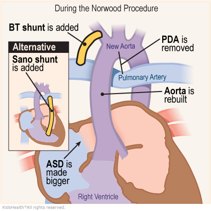 Kidshealth: Hypoplastic Left Heart Syndrome Surgery: The Norwood ...