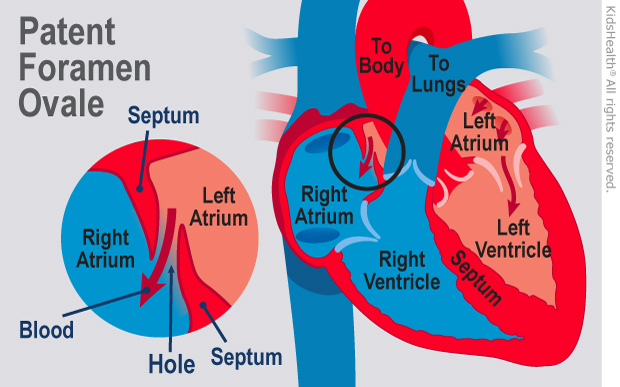 Kidshealth: Patent Foramen Ovale (PFO) | Akron Children's Hospital