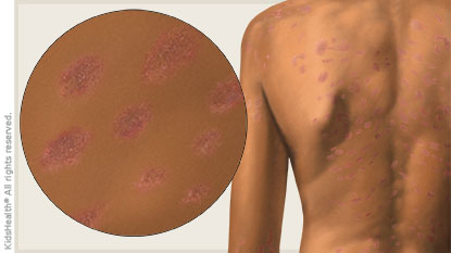 Kidshealth: Pityriasis Rosea | Akron Children's Hospital