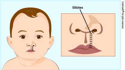 Kidshealth: Cleft Palate With Cleft Lip | Akron Children's Hospital