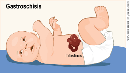 Kidshealth: Gastroschisis | Akron Children's Hospital