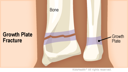 Kidshealth: Growth Plates | Akron Children's Hospital