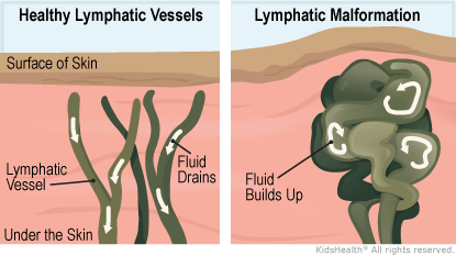 Kidshealth: Lymphatic Malformations | Akron Children's Hospital