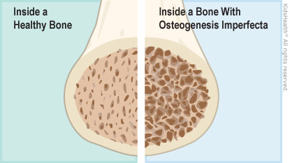 Kidshealth: Osteogenesis Imperfecta (Brittle Bone Disease) | Akron ...