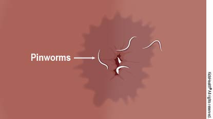 Kidshealth: Pinworm Infections | Akron Children's Hospital