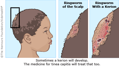 Kidshealth: Ringworm | Akron Children's Hospital