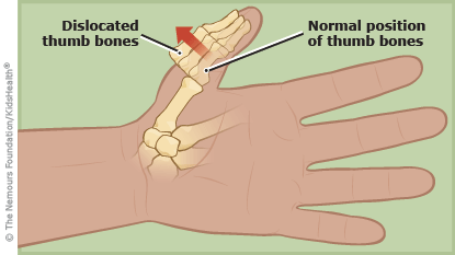 Kidshealth: A to Z: Dislocation, Thumb | Akron Children's Hospital