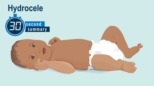 Kidshealth: Quick Summary: Hydrocele | Akron Children's Hospital